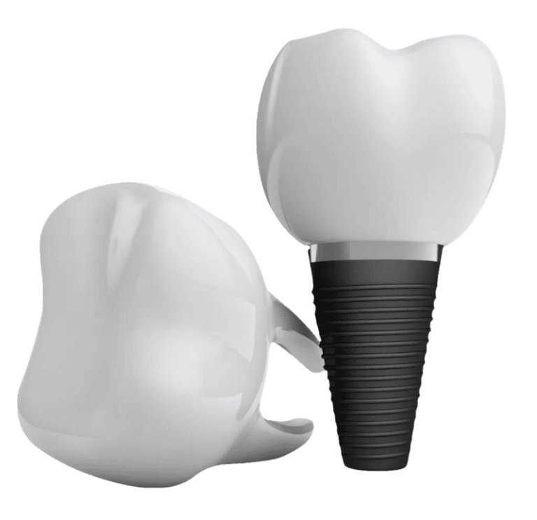 Single Tooth Implants or Bridges in Baton Rouge, LA