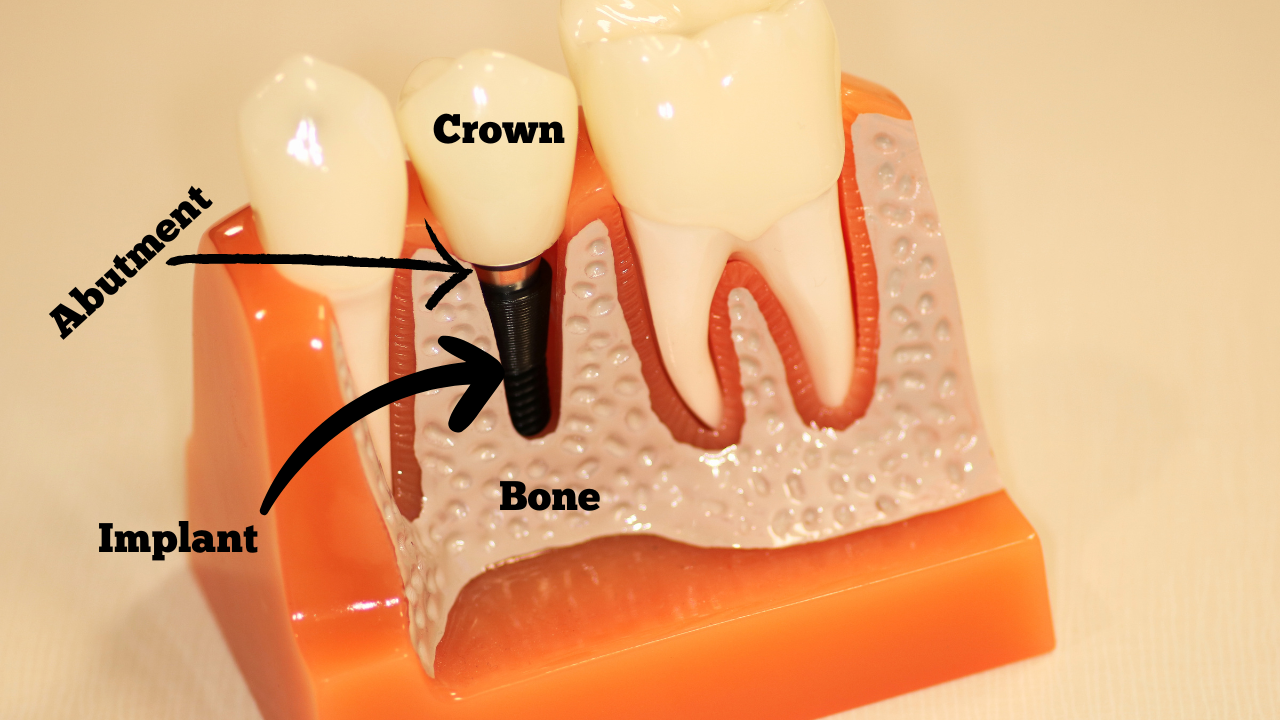 Dental Implant Parts - Crown, Abutment, Implant